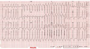 Atrial Fibrillation Controversies | Emergency Medicine Cases