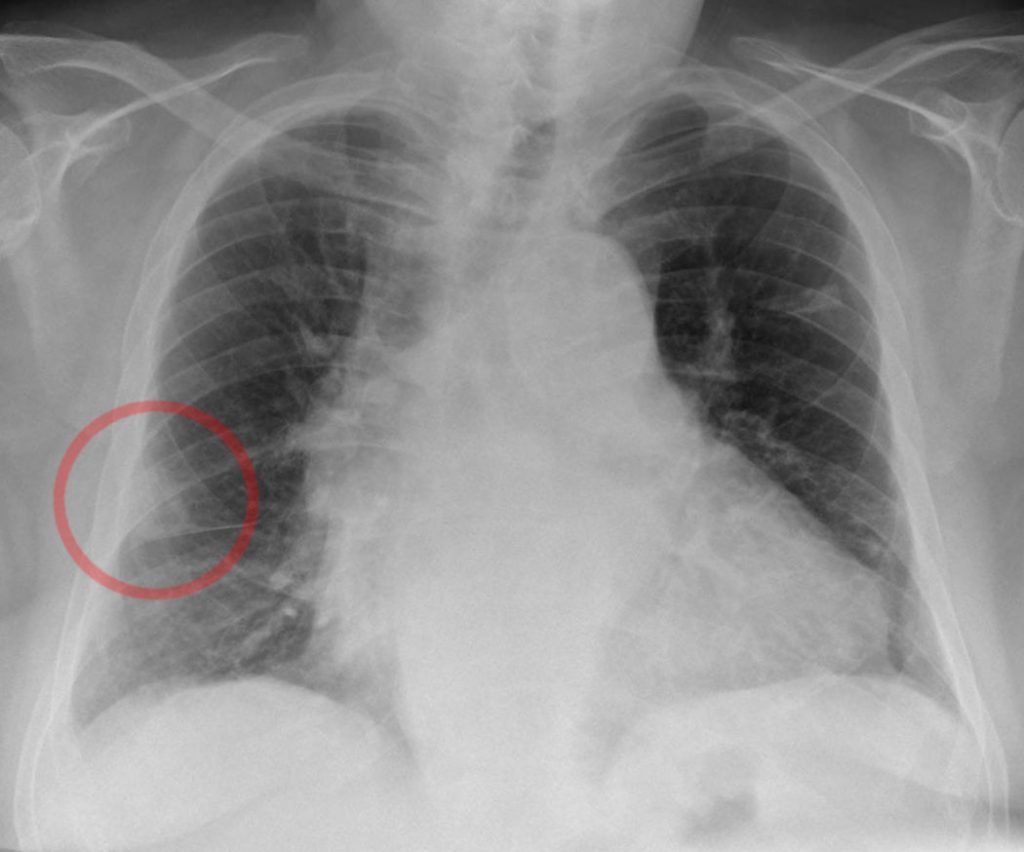 Pulmonary Embolism | Emergency Medicine Cases