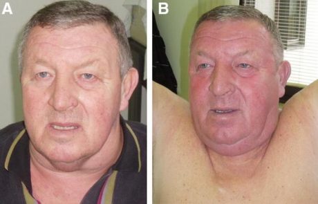 Oncologic Emergencies | Emeregency Medicine Cases