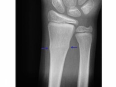 Pediatric Orthopedics | Emergency Medicine Cases