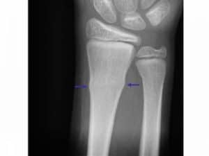 Pediatric Orthopedics | Emergency Medicine Cases
