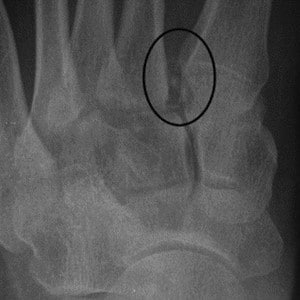 Lisfranc Fleck Sign - Emergency Medicine Cases