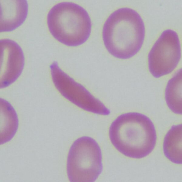 Sickle Cell Acute Chest Syndrome