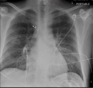 CritCases 2 - Is this Septic Shock with Pneumonia? - Emergency Medicine ...