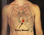 CritCases 3 - GSW to the Chest - Emergency Medicine Cases