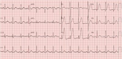 Emergency Management of Hyperkalemia | EM Cases Podcast