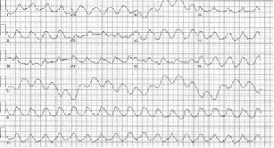 Post Arrest Hyperkalemia | EM Cases | Best Case Ever