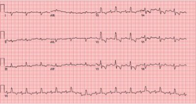 Pulmonary Hypertension | CritCases | EM Cases