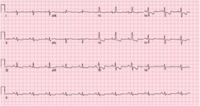 Pulmonary Hypertension | CritCases | EM Cases