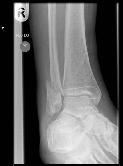 Commonly Missed Ankle Injuries | Emergency Medicine Cases | EM Cases