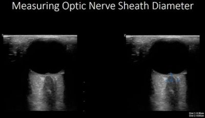 POCUS Cases | Idiopathic Intracranial Hypertension and Ocular POCUS