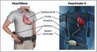LVAD Management in GI Bleed | CritCases | Emergency Medicine Cases
