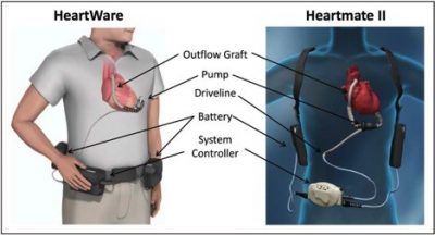 LVAD Management in GI Bleed | CritCases | Emergency Medicine Cases