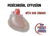 Pericardial Effusion POCUS | POCUS Cases | Emergency Medicine Cases