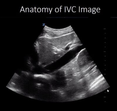 IVC POCUS for Assessment of Volume Status | POCUS Cases | EM Cases