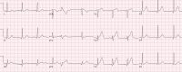 early repolarization or anterior STEMI | ECG cases | EM cases