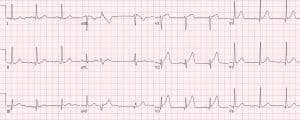 early repolarization or anterior STEMI | ECG cases | EM cases