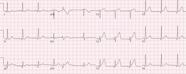 early repolarization or anterior STEMI | ECG cases | EM cases