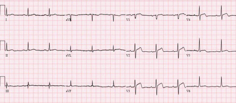 early repolarization or anterior STEMI | ECG cases | EM cases