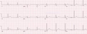 Subtle Inferior MI | ECG cases | EM cases