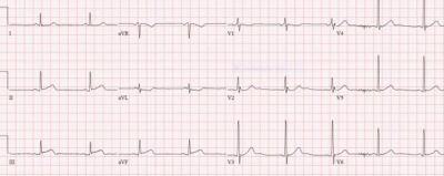 Subtle Inferior MI | ECG cases | EM cases