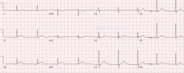 Subtle Inferior MI | ECG cases | EM cases