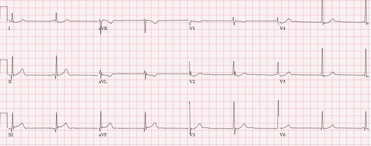 Subtle Inferior MI | ECG cases | EM cases