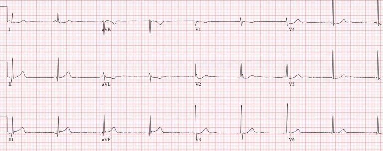 Subtle Inferior MI | ECG cases | EM cases