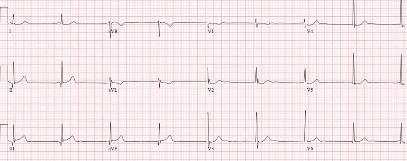 Subtle Inferior MI | ECG cases | EM cases