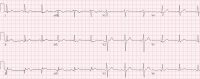 Subtle Inferior MI | ECG cases | EM cases