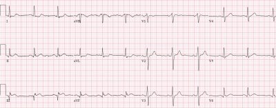 Subtle Inferior MI | ECG cases | EM cases
