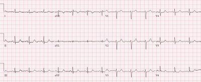 Subtle Inferior MI | ECG cases | EM cases