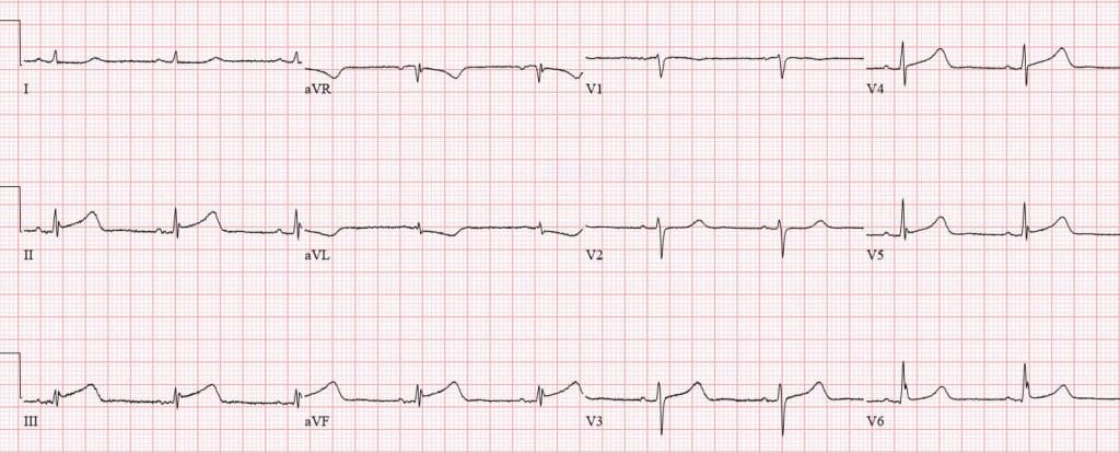 Subtle Inferior MI | ECG cases | EM cases