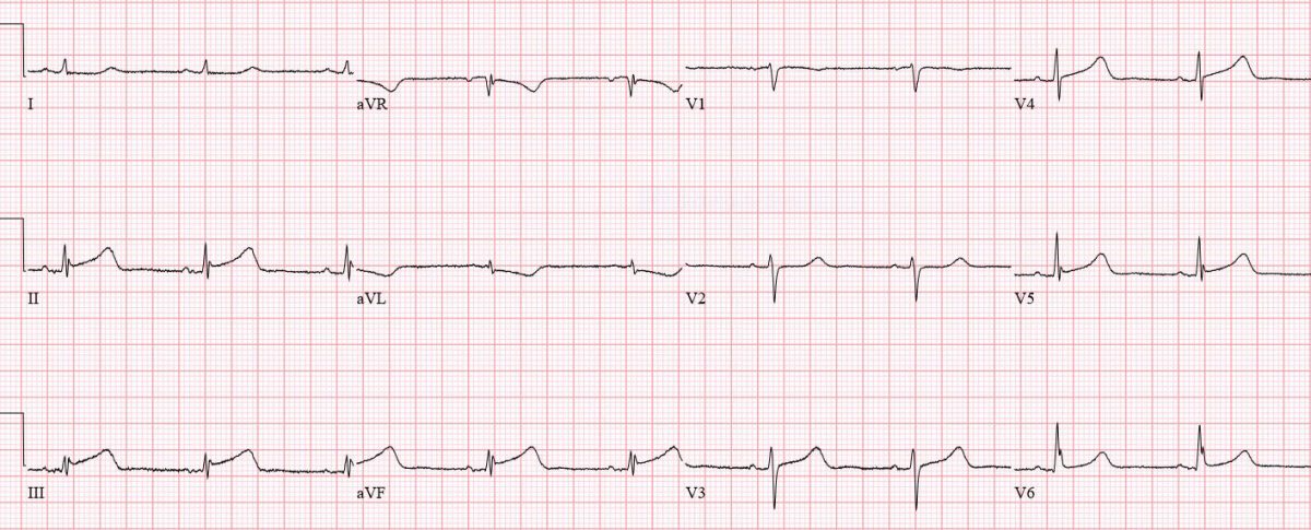 Subtle Inferior MI | ECG cases | EM cases