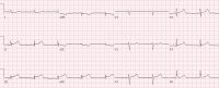 Subtle Inferior MI | ECG cases | EM cases