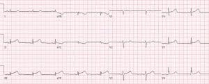 Subtle Inferior MI | ECG cases | EM cases
