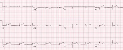 Subtle Inferior MI | ECG cases | EM cases