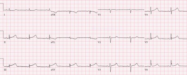 Subtle Inferior MI | ECG cases | EM cases