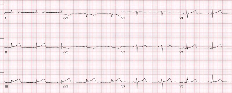 Subtle Inferior MI | ECG cases | EM cases