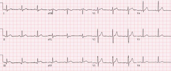 Subtle Inferior MI | ECG cases | EM cases