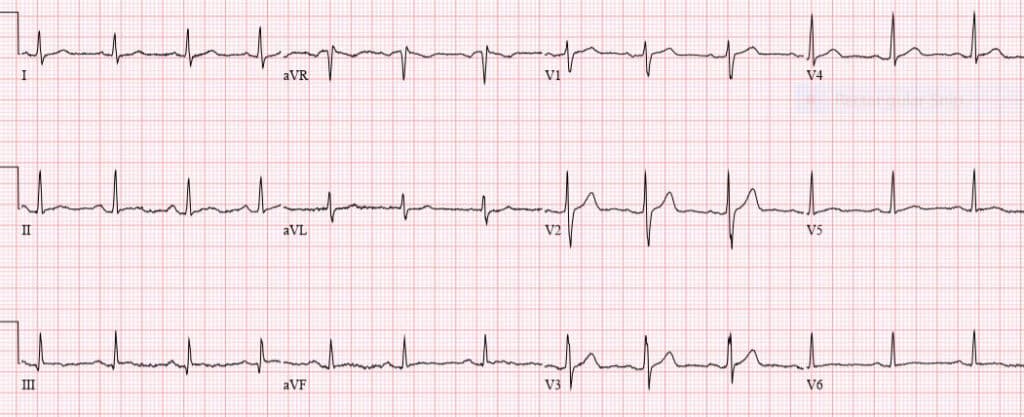 Subtle Inferior MI | ECG cases | EM cases