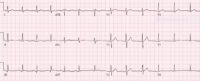 Subtle Inferior MI | ECG cases | EM cases