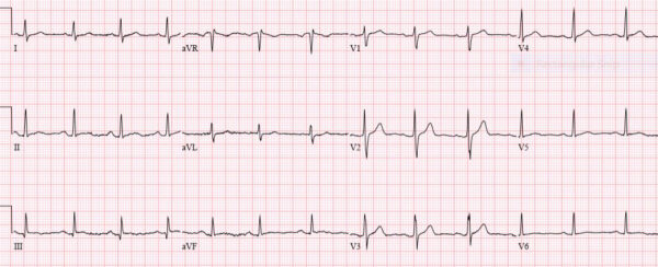Subtle Inferior MI | ECG cases | EM cases
