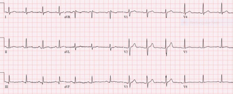 Subtle Inferior MI | ECG cases | EM cases