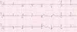Subtle Inferior MI | ECG cases | EM cases