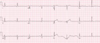 Subtle Inferior MI | ECG cases | EM cases