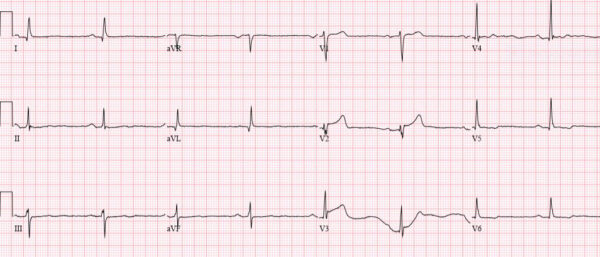 Subtle Inferior MI | ECG cases | EM cases