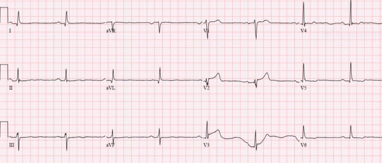 Subtle Inferior MI | ECG cases | EM cases