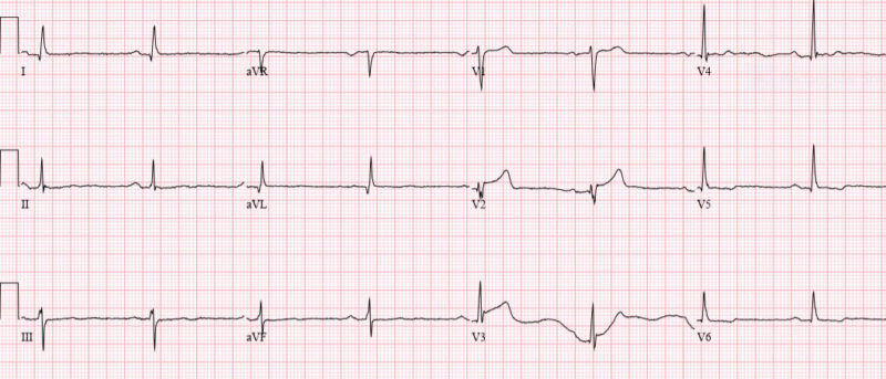 Subtle Inferior MI | ECG cases | EM cases