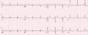 Subtle Inferior MI | ECG cases | EM cases